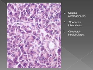 Diabetes Tipo 1 Páncreas Histología
