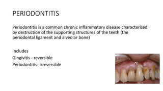 Diabetes and periodontitis | PPTX