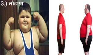 Diabetes(मधुमेह final) DR. Parshant | PPTX