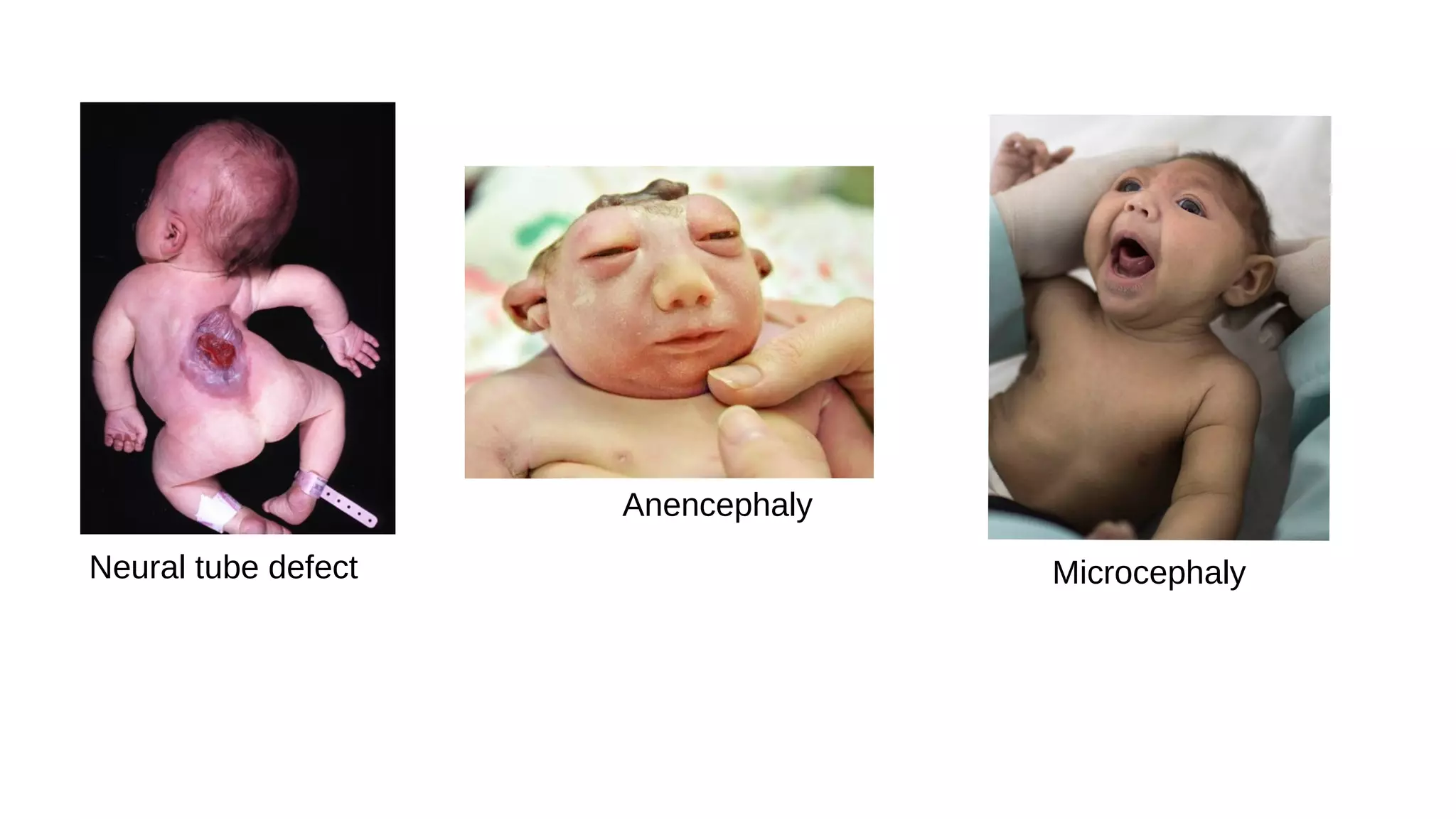 Diabetes in pregnancy-overt diabetes: type I DM, type II DM,Gestational ...