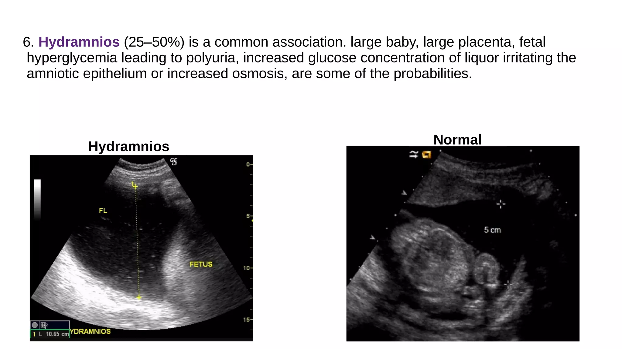 Diabetes in pregnancy-overt diabetes: type I DM, type II DM,Gestational ...