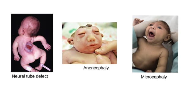 Diabetes in pregnancy-overt diabetes: type I DM, type II DM,Gestational ...