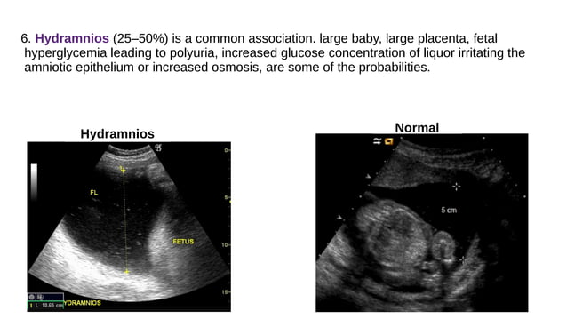Diabetes in pregnancy-overt diabetes: type I DM, type II DM,Gestational ...