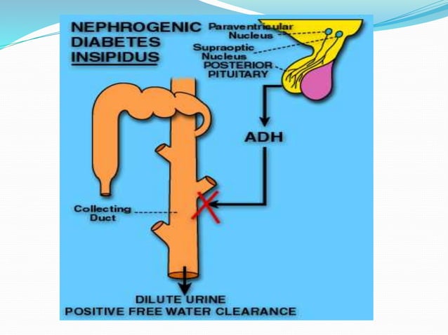 Diabetes insipidus | PPT