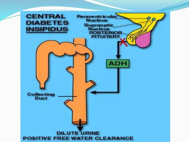Diabetes insipidus | PPTX | Endocrine and Metabolic Diseases | Diseases ...