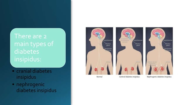 Diabetes insipidus.pptx | Endocrine and Metabolic Diseases | Diseases ...
