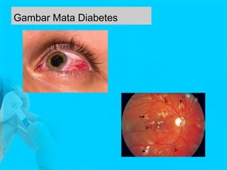 Diabetes Melitus_BRI 27 Agustus 2019.pptx