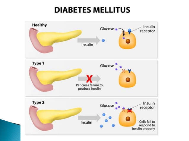 Diabetes mellitus- Easy explanation for Nurses | PDF