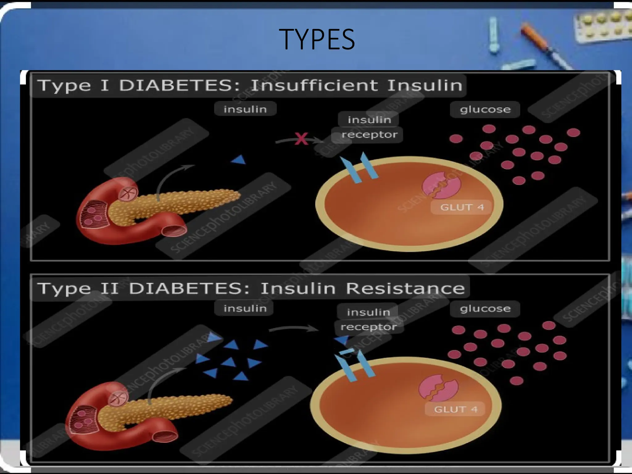Diabetes mellitus and it's types with quiz . | PPTX