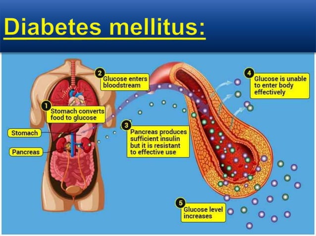 Diabetes mellitus Type 1 and Type 2 | PPTX | Endocrine and Metabolic ...