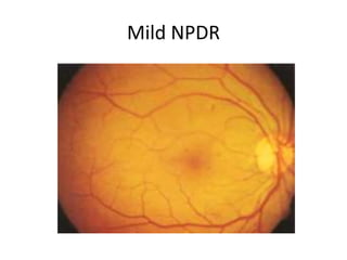 Diabetes retinopathy | PPTX