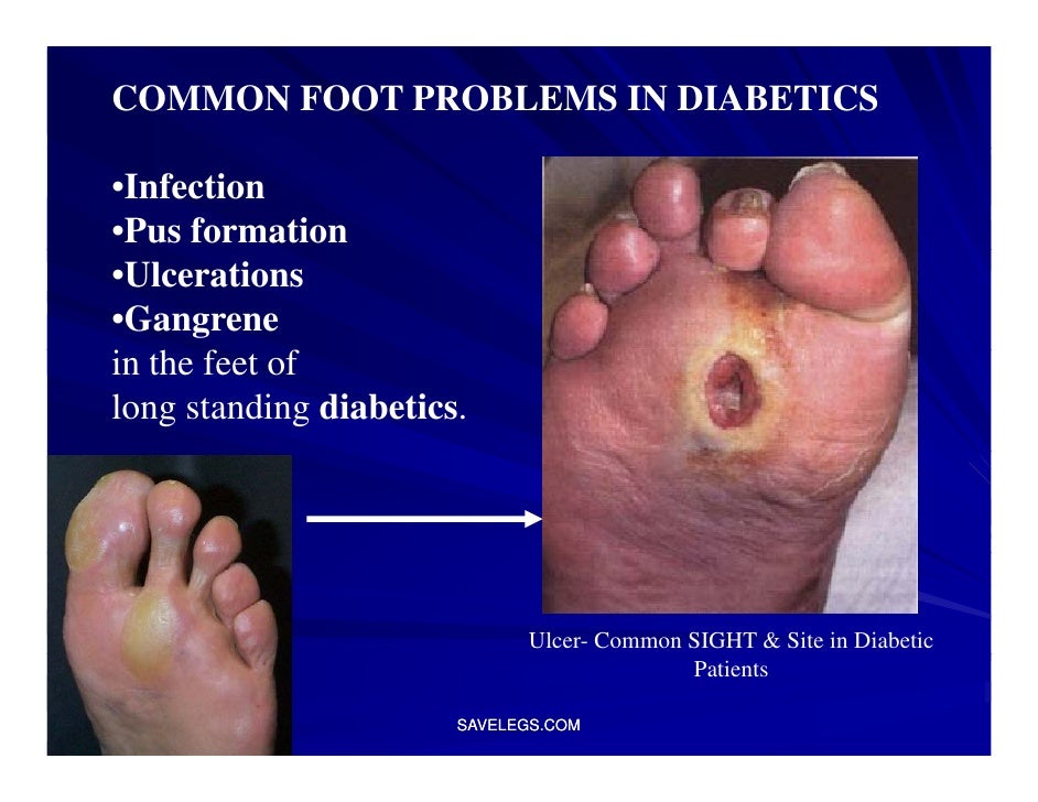 Diabetic Foot Globally
