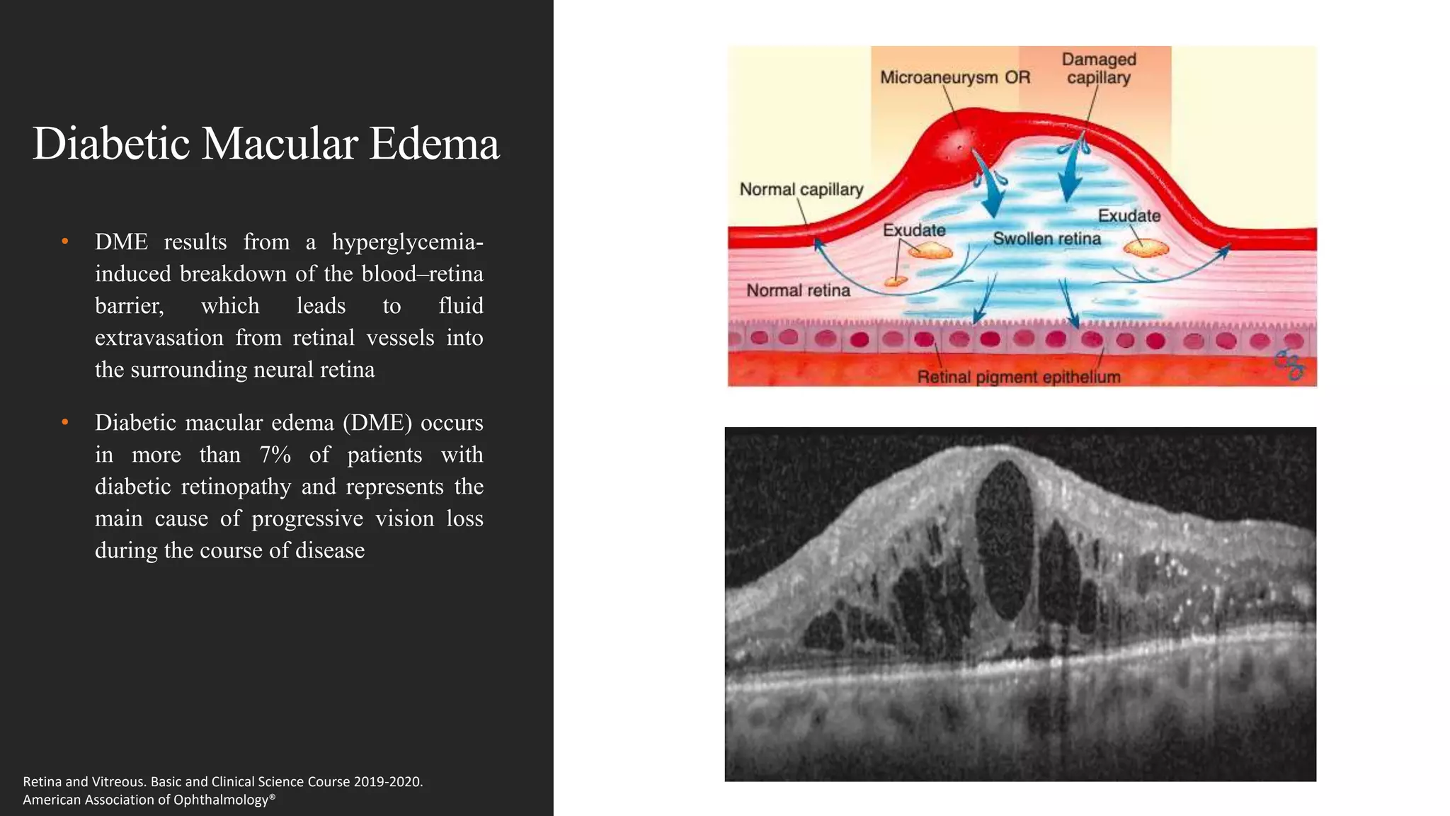 Diabetic-Macular-Edema-.rova-virgana.pptx