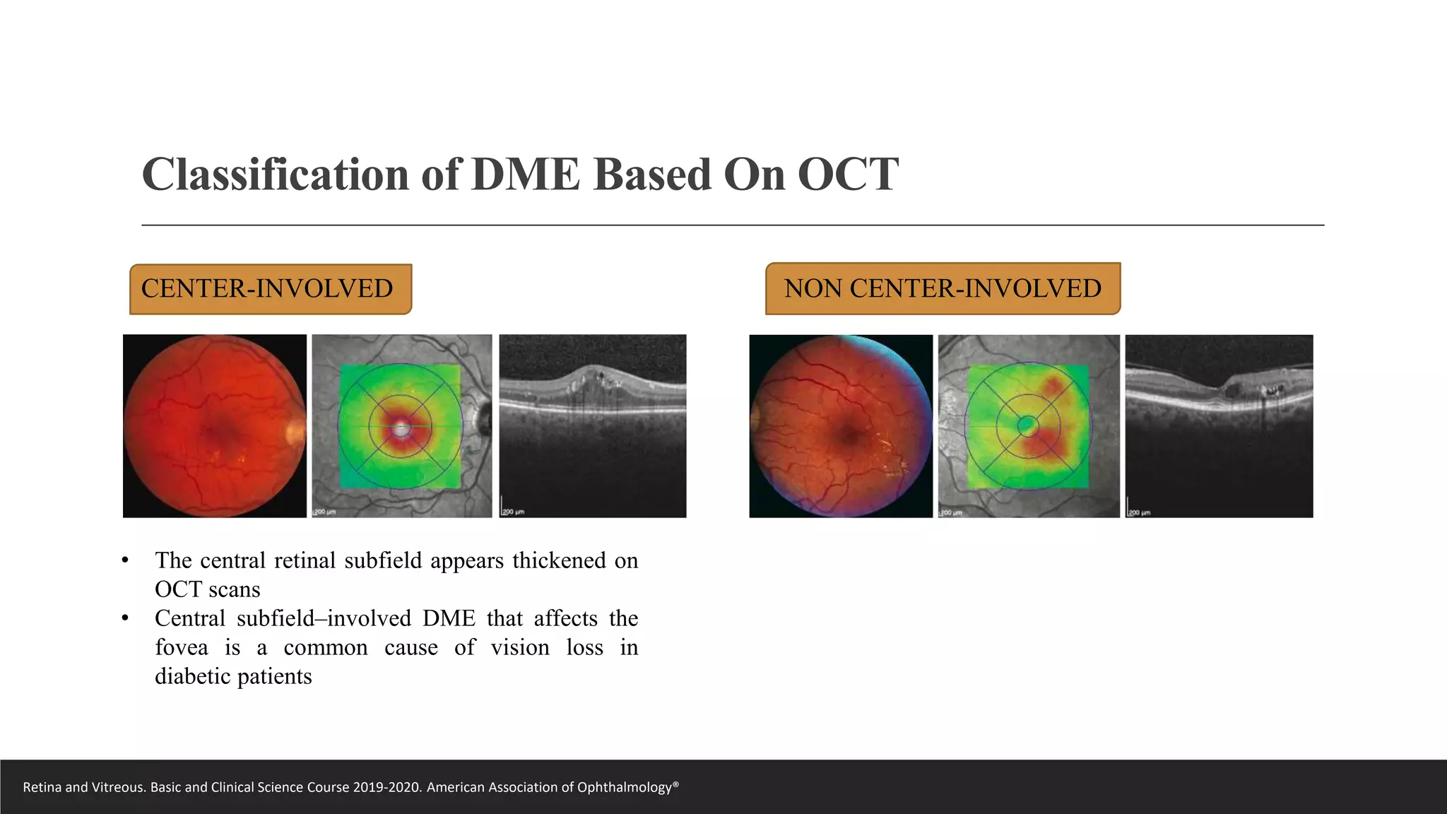 Diabetic-Macular-Edema-.rova-virgana.pptx