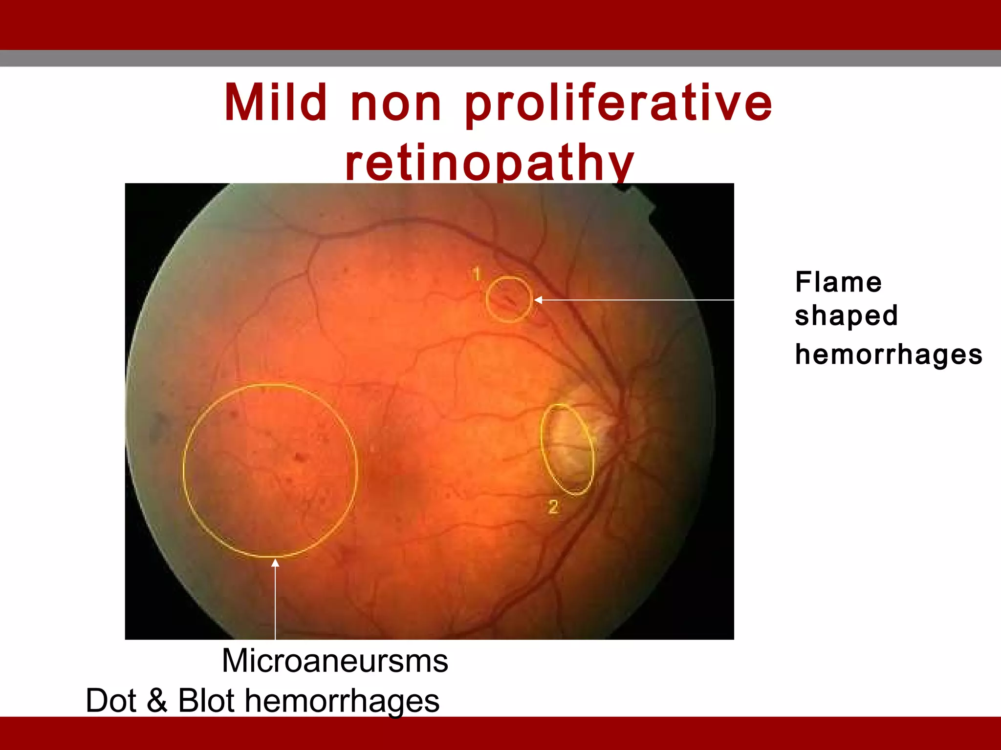 Diabetic Microvascular Complications | PPT