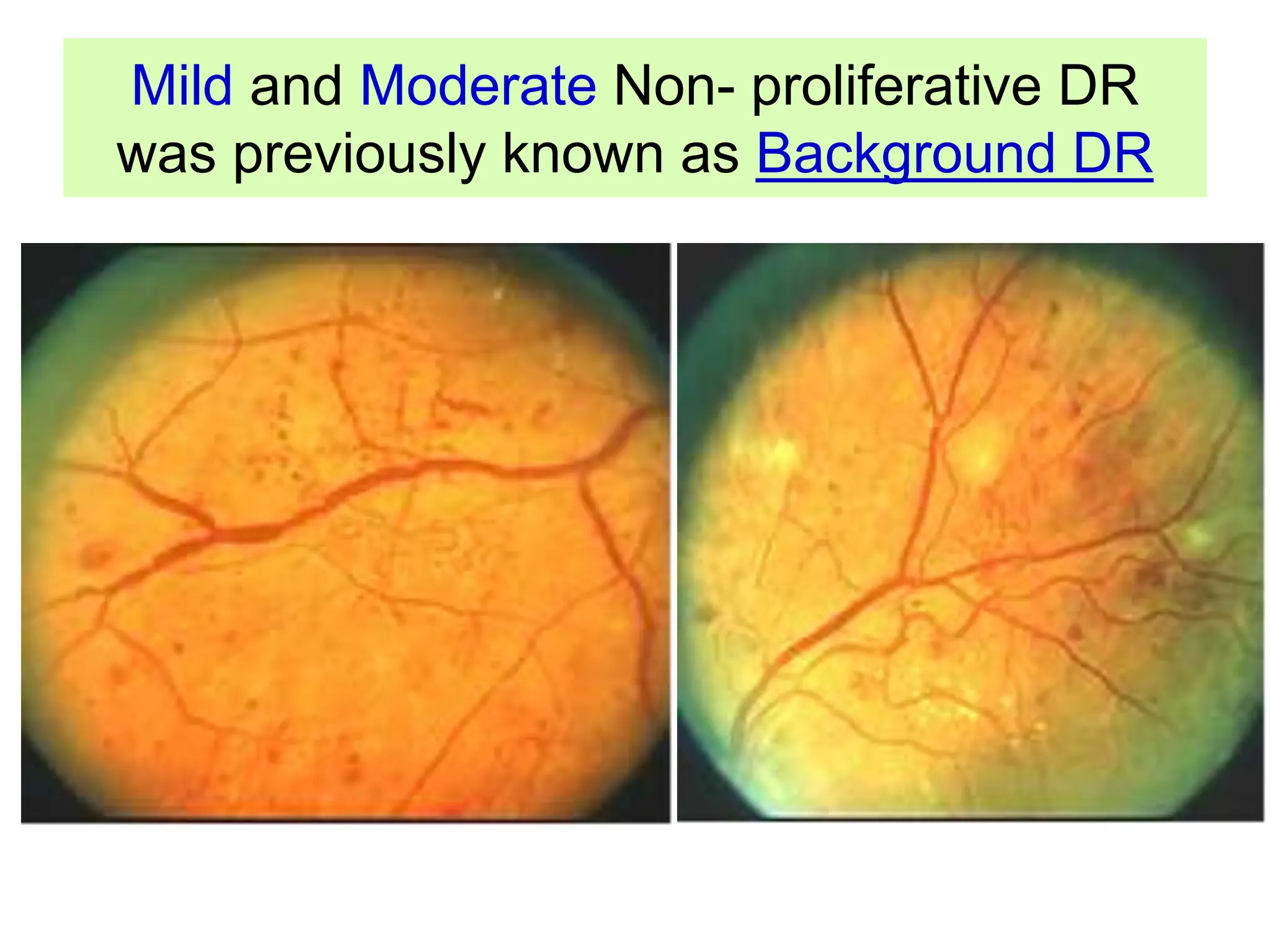 A Deep Learning Approach for the Detection of Diabetic Retinopathy | PPT