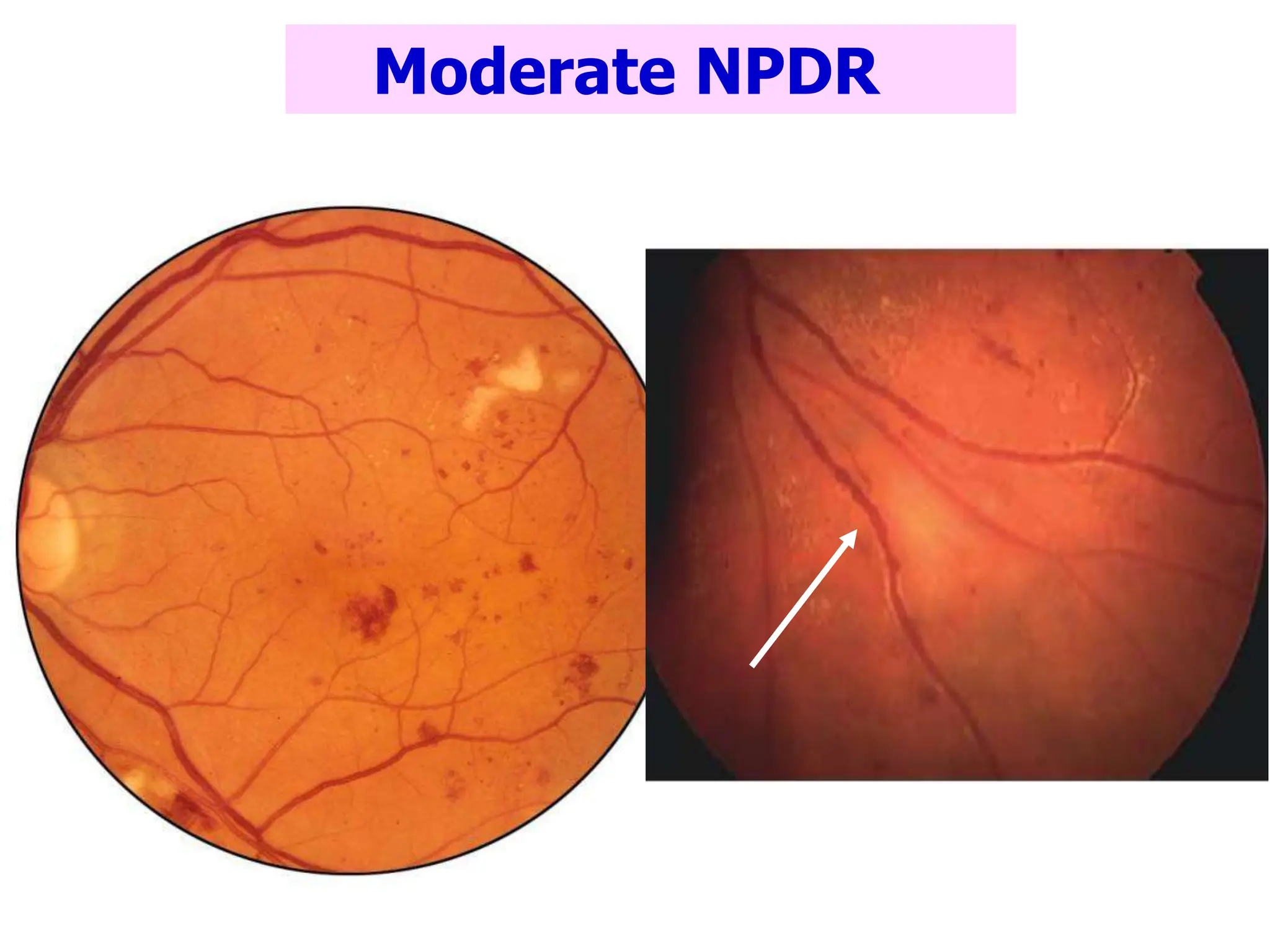 A Deep Learning Approach for the Detection of Diabetic Retinopathy | PPT