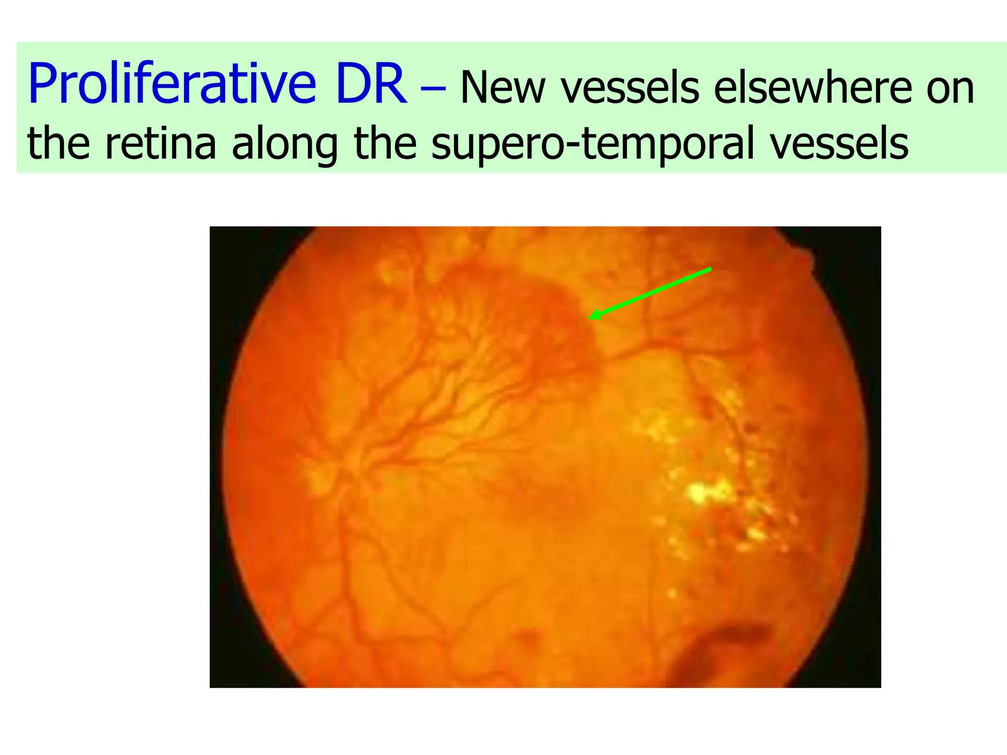 A Deep Learning Approach for the Detection of Diabetic Retinopathy | PPT