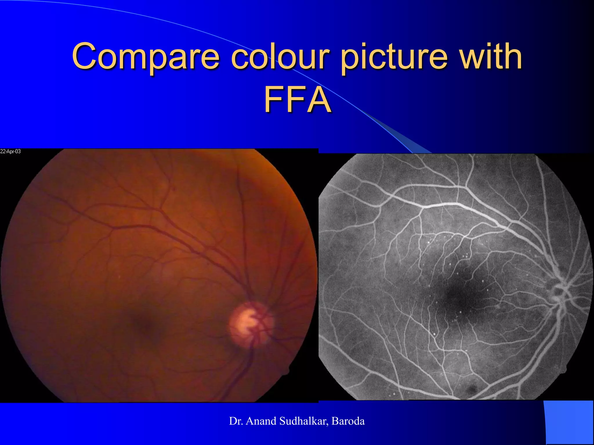 Diabetic colour & ffa 11 4-2010 | PPTX