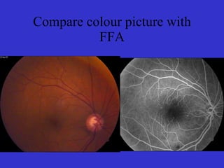 Diabetic Colour & Ffa2 | PPT | Eye and Vision Conditions | Diseases and ...
