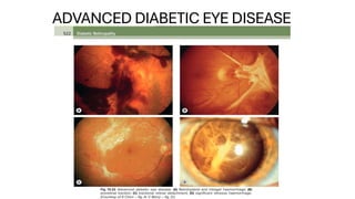 Diabetic Eye Disease: clinical approach and management.pdf