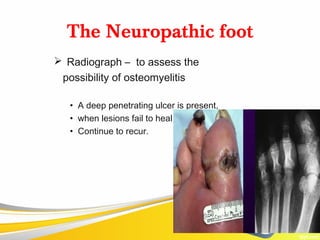 Neuropathic Ulcer