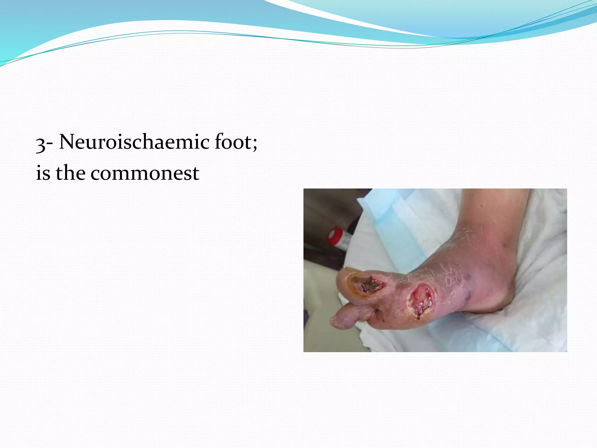 management Diabetic foot | PPTX