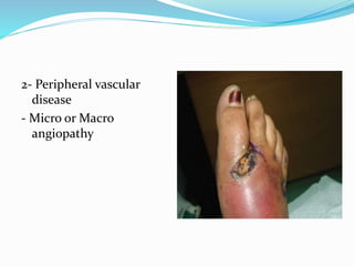 management Diabetic foot | PPTX