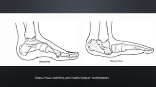 Diabetic foot | PPTX