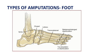 DIABETIC FOOT.....powerpoint for surgery | PPTX
