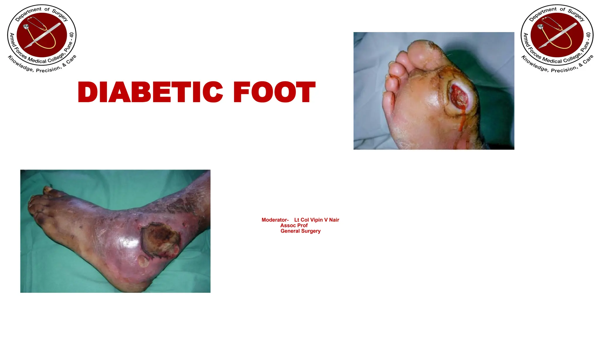 diabetic foot presentation and management | PPTX