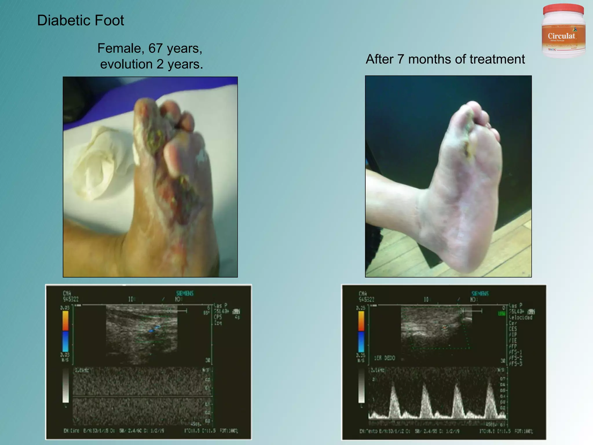 Diabetic Foot Evidence 2010 | PPT