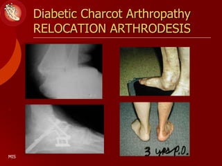 Diabetic foot | PPT