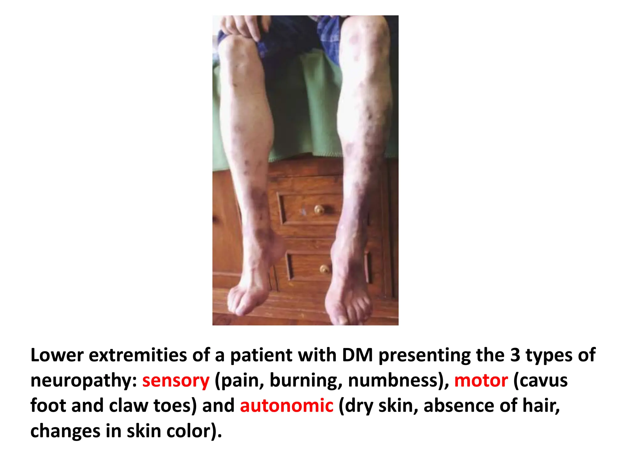 Diabetic Foot slide show vascular surgery | PPTX