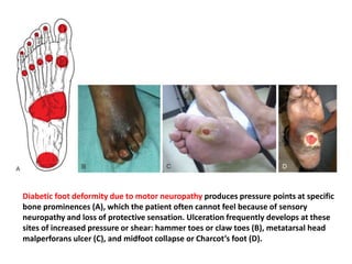 Diabetic Foot slide show vascular surgery | PPTX