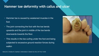 Diabetic foot and its complications -final.pptx