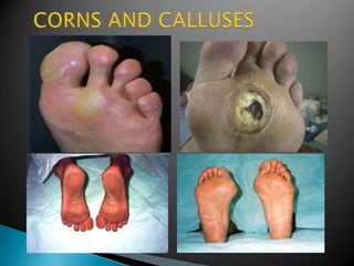 Diabetic foot care | PPT