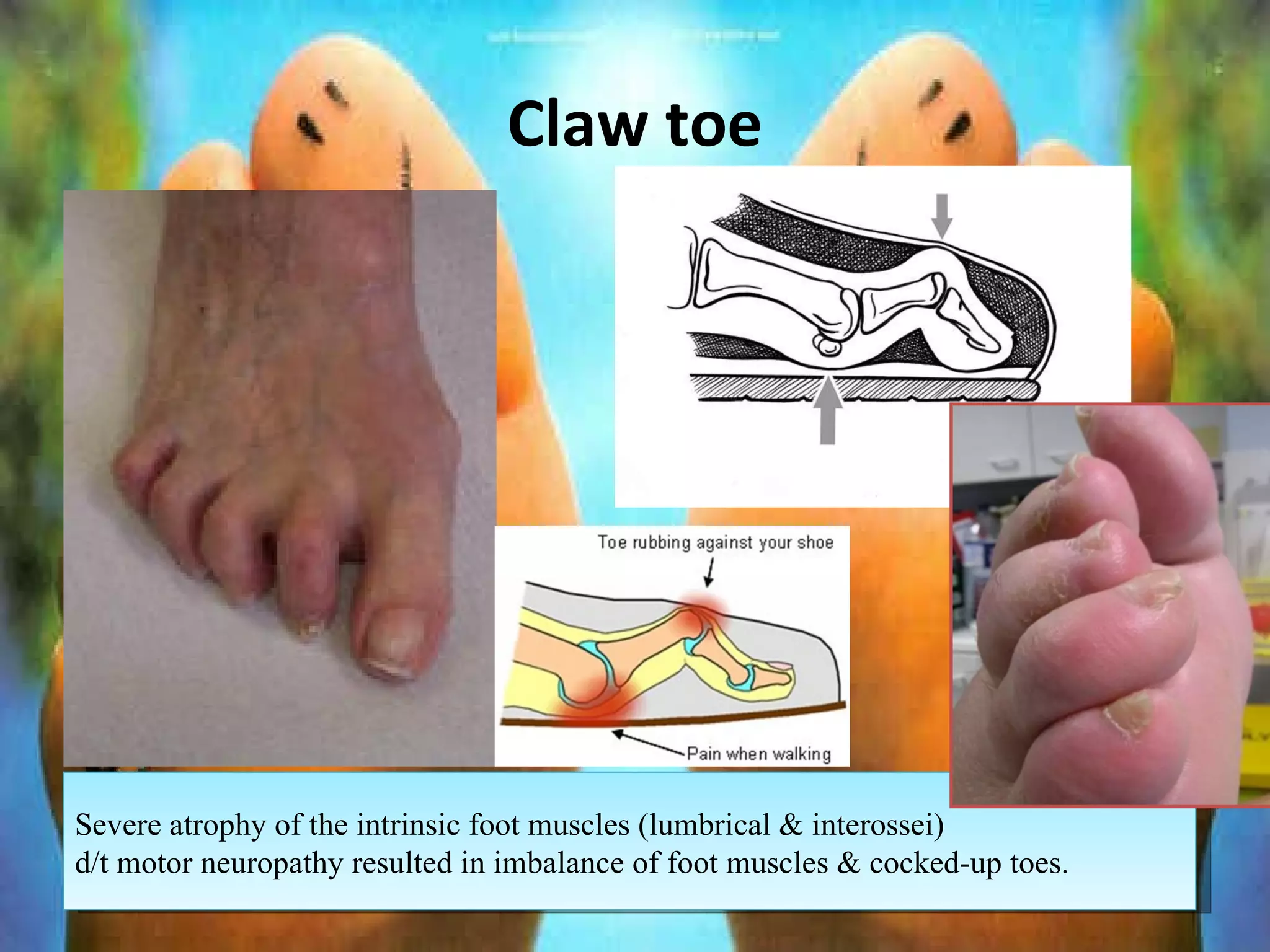 Diabetic foot + gangrene | PPT