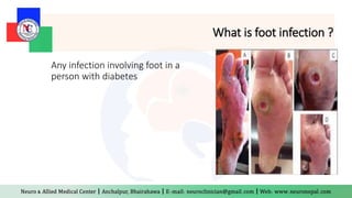 Diabetic foot infection | PPTX