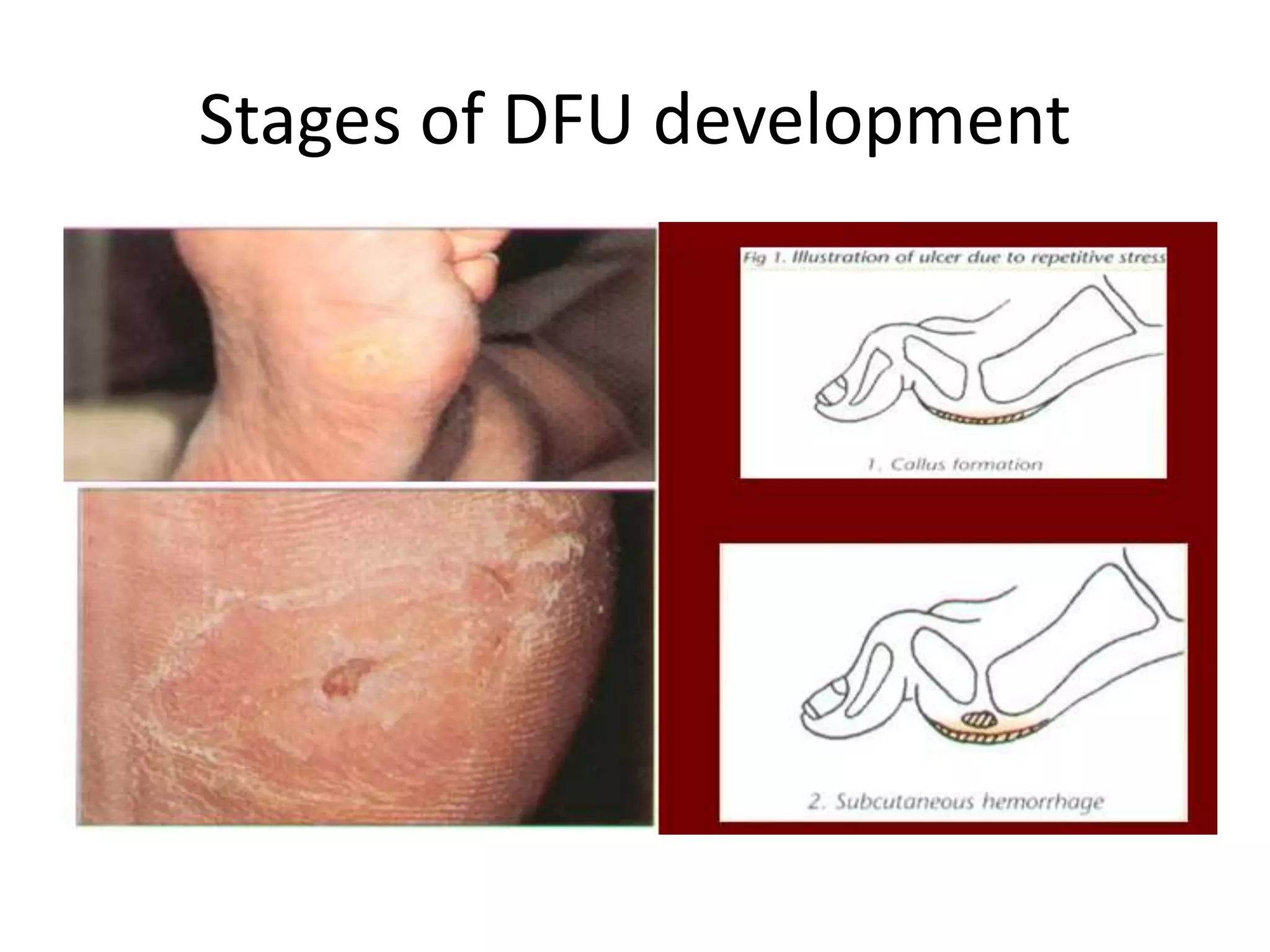 Diabetic foot Dr Jitesh Jain | PPTX