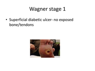 Diabetic foot Dr Jitesh Jain | PPTX