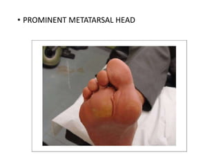 DIABETIC FOOT - INVESTIGATIONS AND CLINICAL FEATURES | PPTX