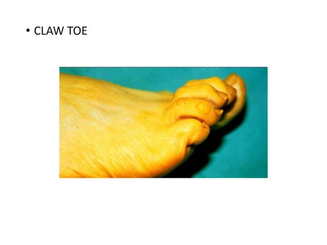 DIABETIC FOOT - INVESTIGATIONS AND CLINICAL FEATURES | PPT