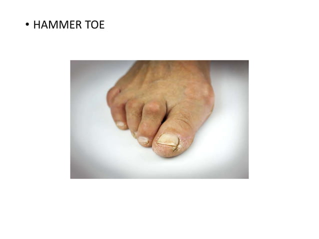 DIABETIC FOOT - INVESTIGATIONS AND CLINICAL FEATURES | PPT