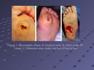 Diabetic foot ortho view | PPT