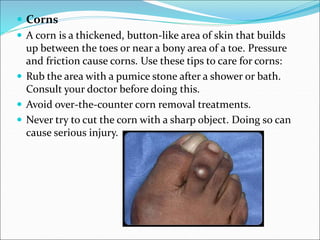 Diabetic foot power point | PPTX