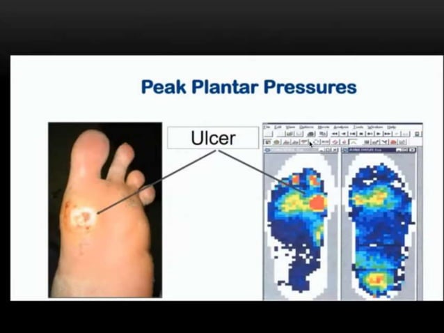 Diabetic foot reconstruction | PPTX