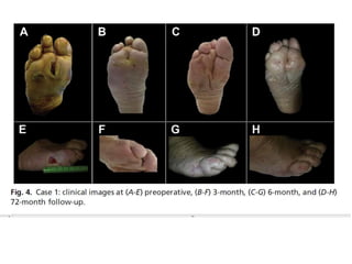 Diabetic foot reconstruction | PPTX