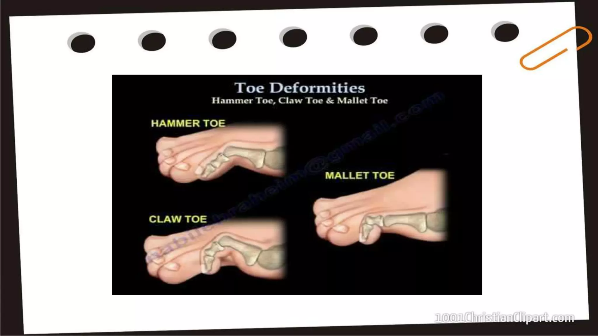DIABETIC FOOT & STI seminar.pptx