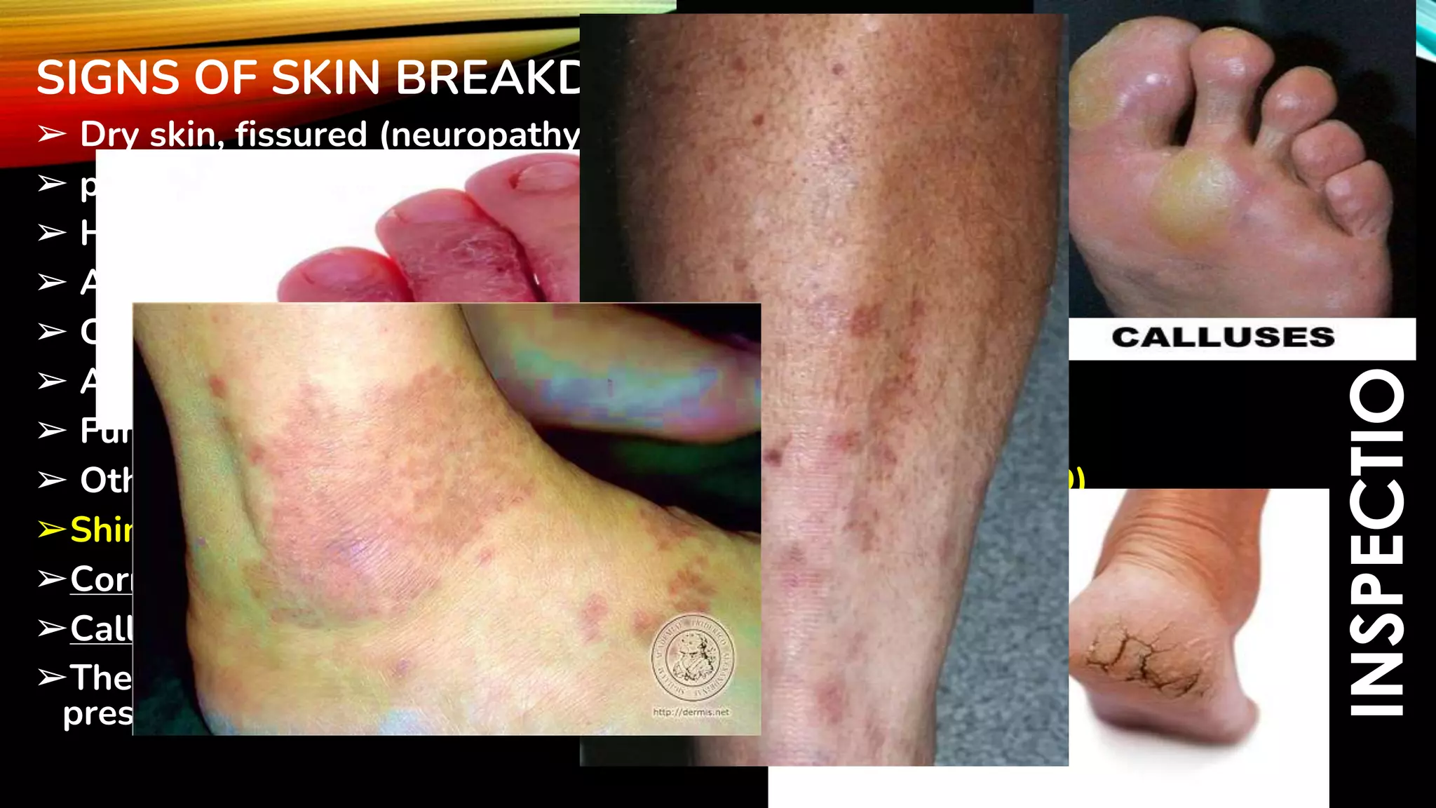 DIABETIC FOOT & STI seminar.pptx